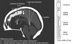Falx cerebri Calcifications and Ossifications in CT Scans - A Data ...